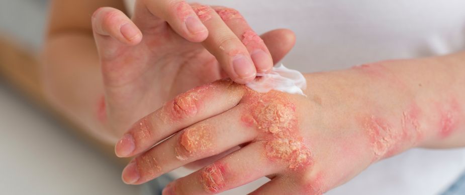 5 Types Of Common Fungal Infections, Know Their Symptoms And Treatment ...